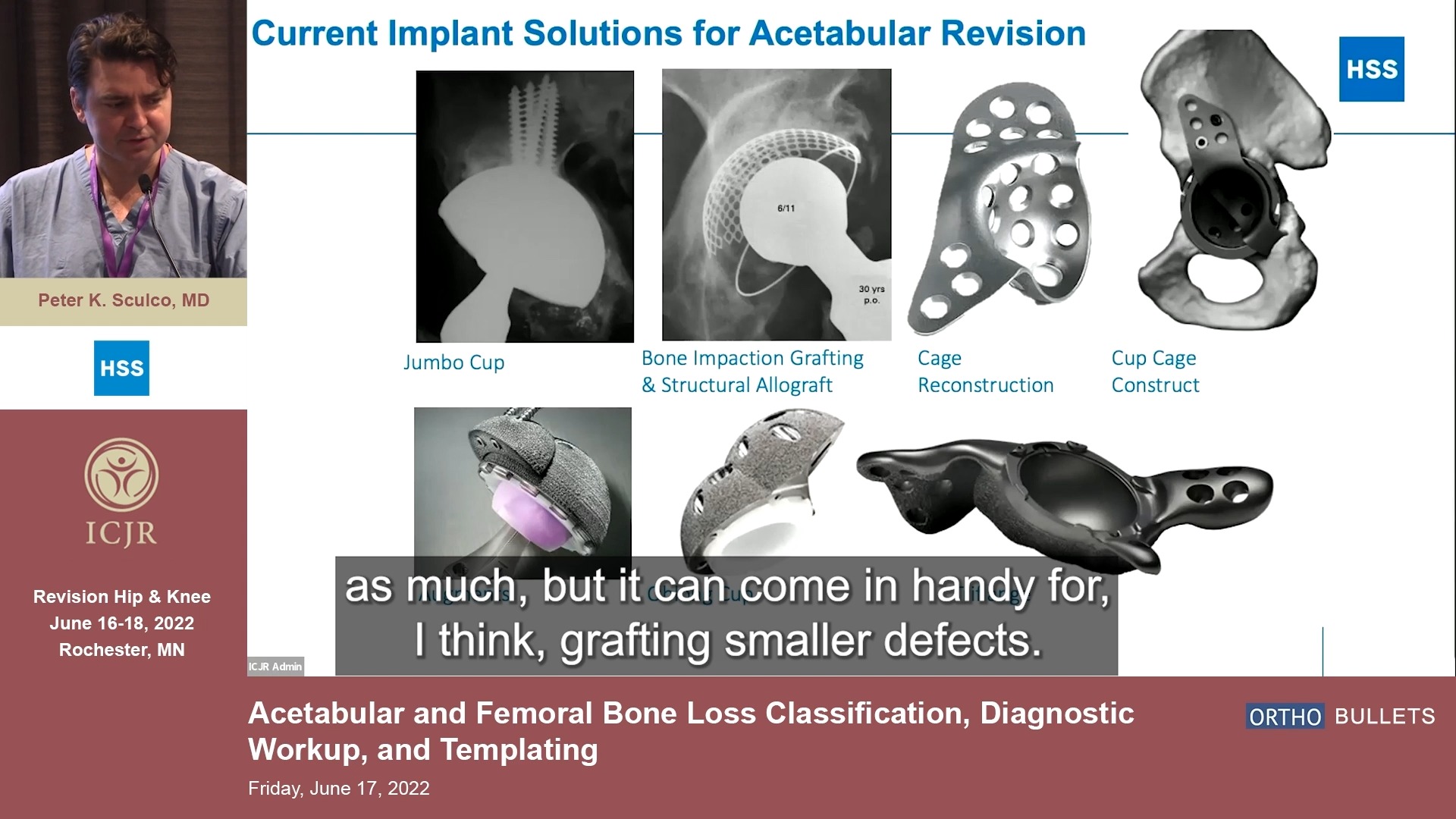 Orthobullets Acetabular And Femoral Bone Loss Classification Diagnostic Workup And