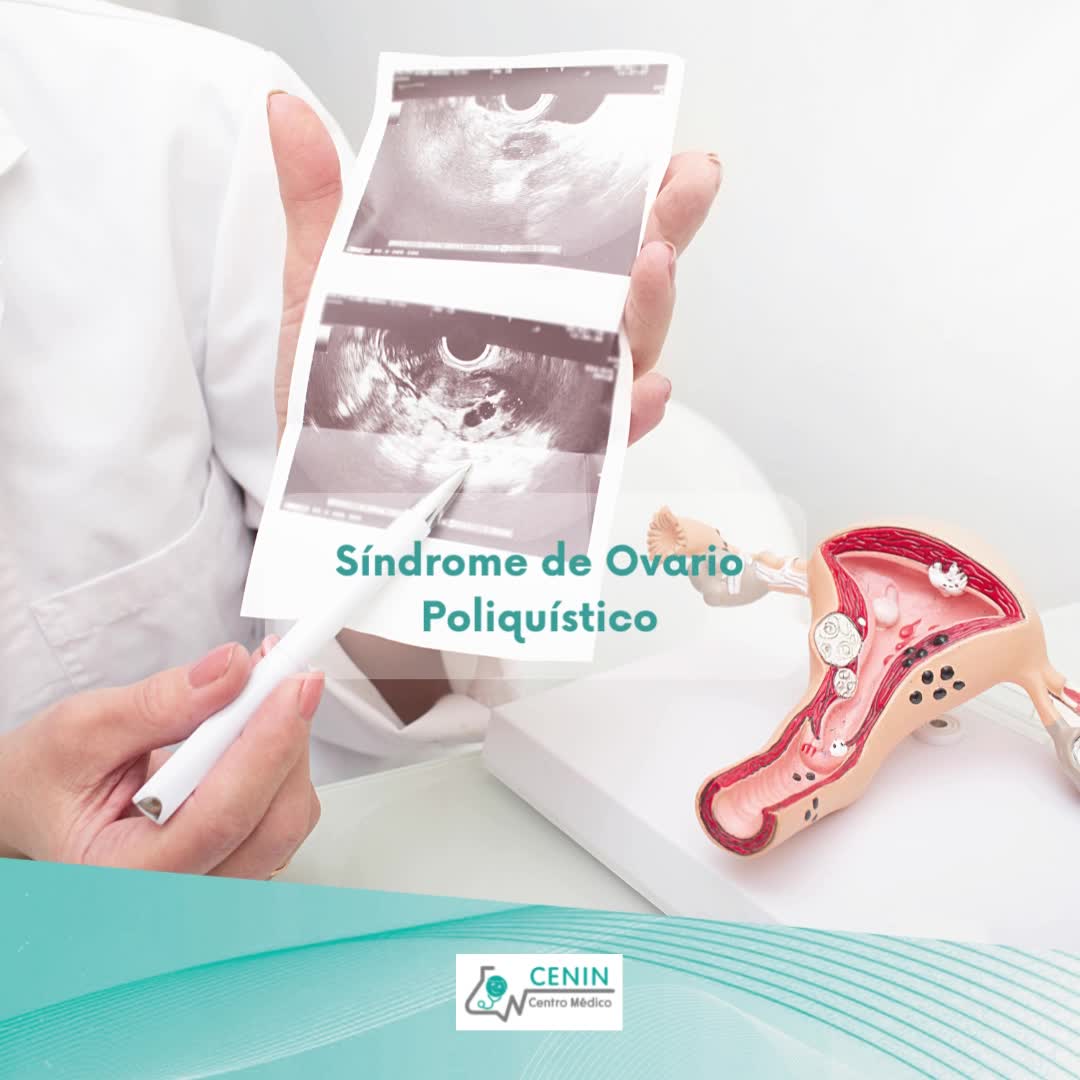 Síndrome De Ovario Poliquístico Entre El 5 Y El 10 De Las Mujeres En 3132