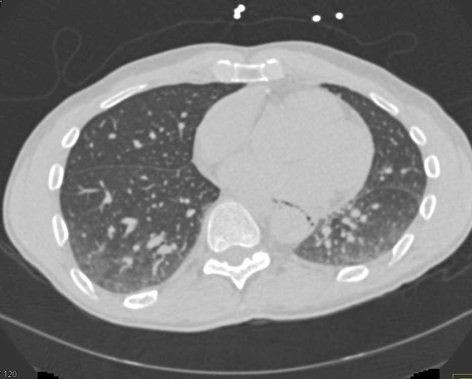 Severe Esophagitis With Pneumomediastinum Ctisus Cutting Edge
