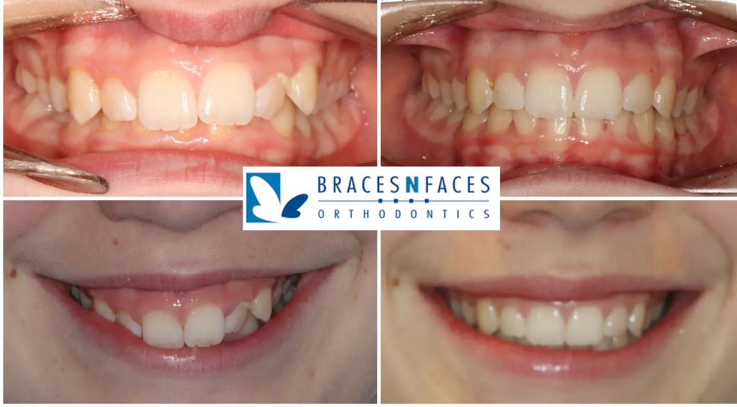 Hump Day ️ Deep Bite Braces N Faces Orthodontics 4932