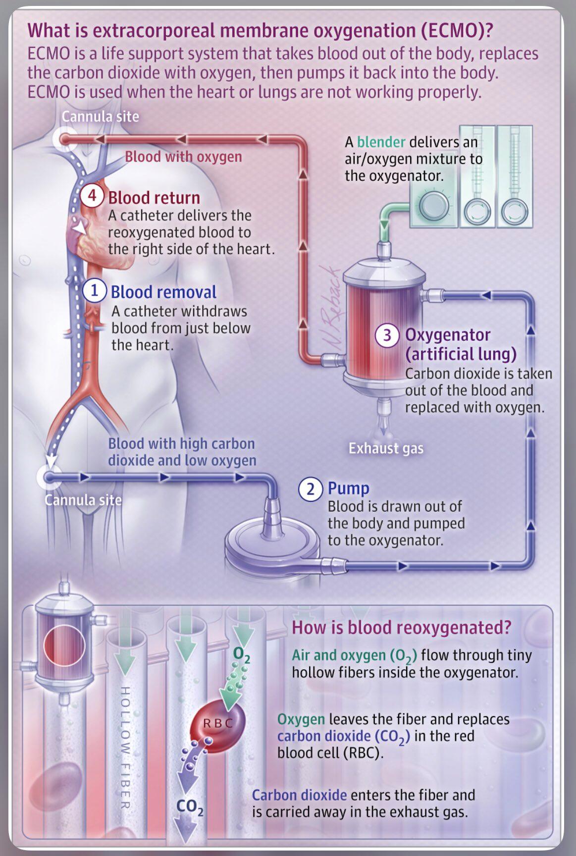 An Overview Of Ecmo For Laymen Pandemic Science