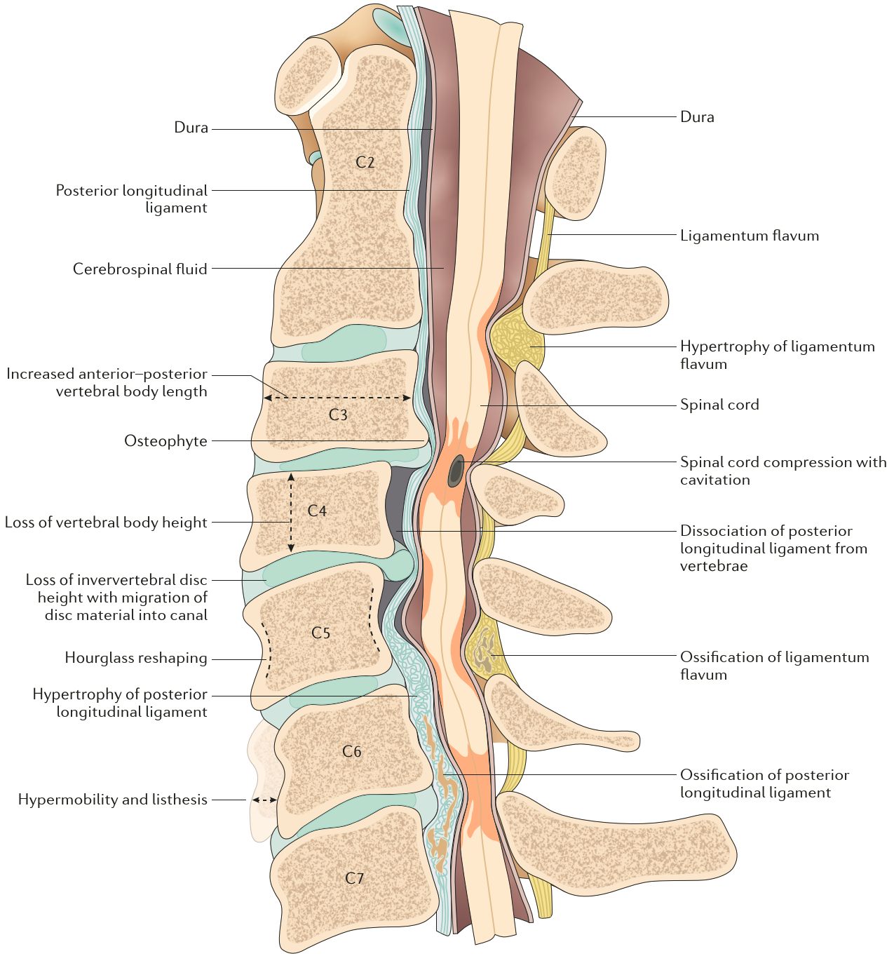 Pathoanatomy Of Degenerative Physio Meets Science 1691