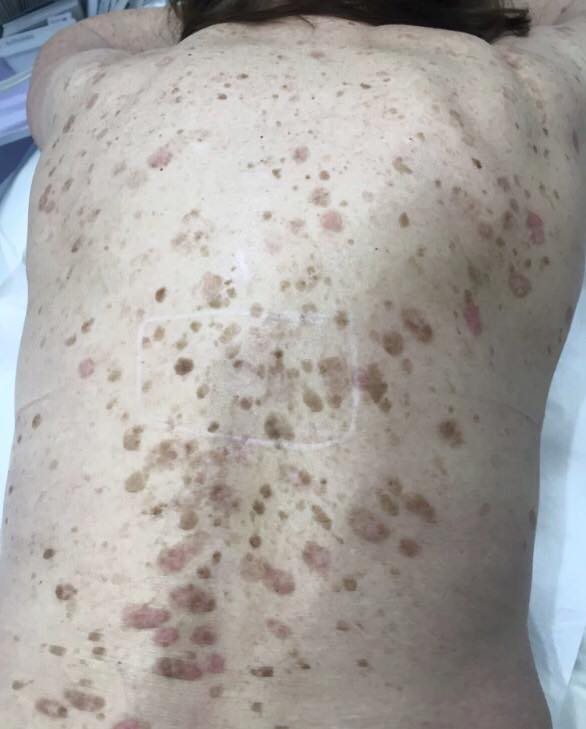 Seborrheic Keratosis Laser City Laser And Skin Clinic 3571