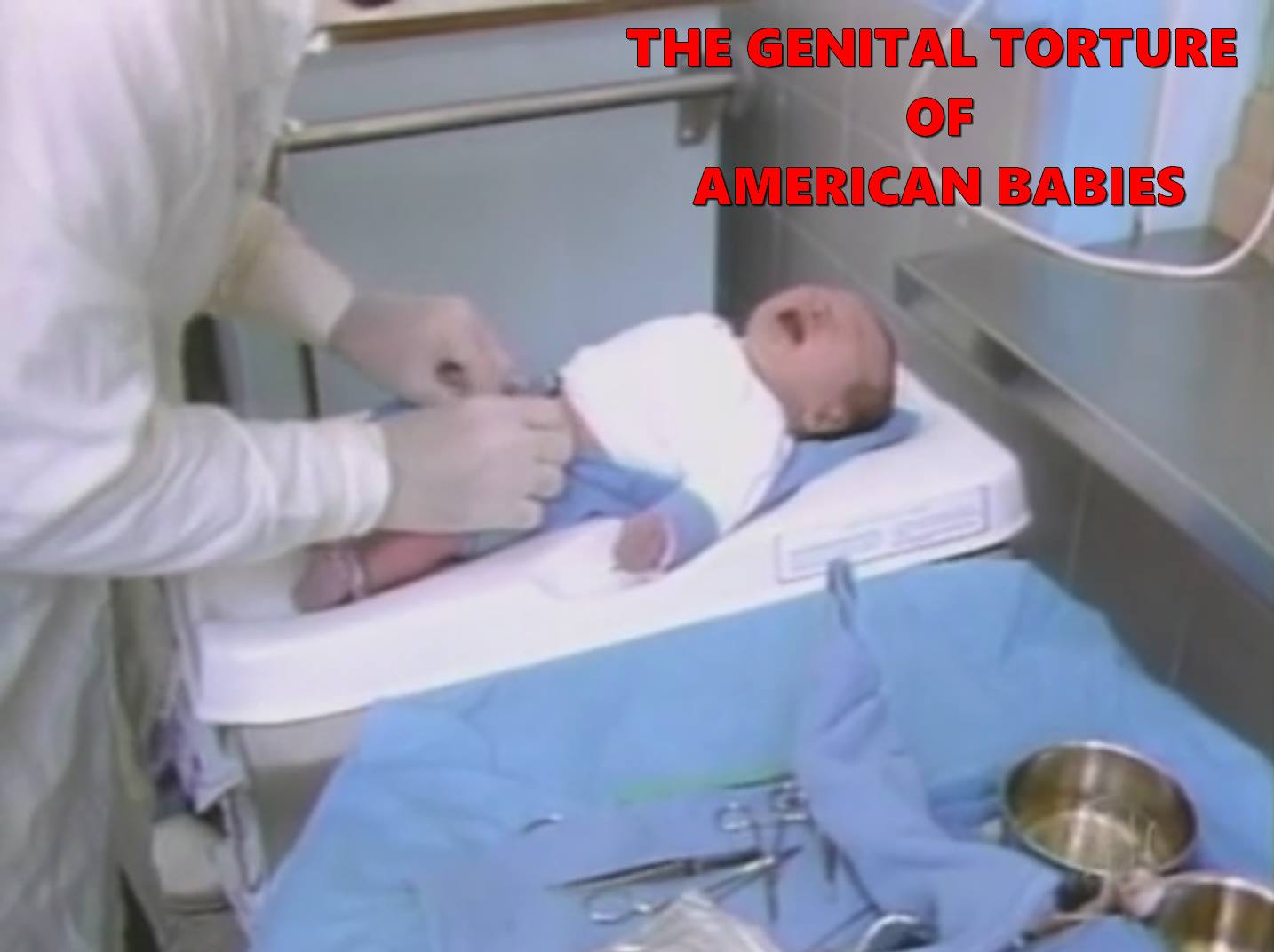 V Cut Circumcision