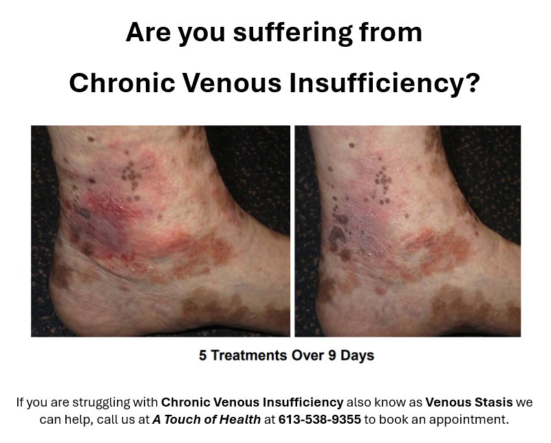 A Touch Hi Everyone Chronic Venous Insufficiency Cvi Also Known