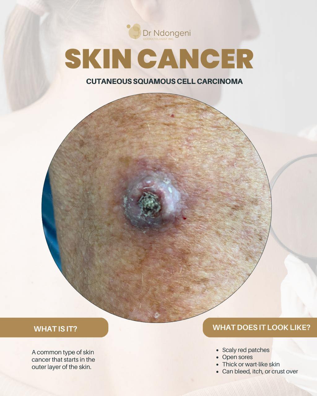 Dr Cutaneous Squamous Cell Carcinoma Cscc Is A Type Of Skin Cancer 7046