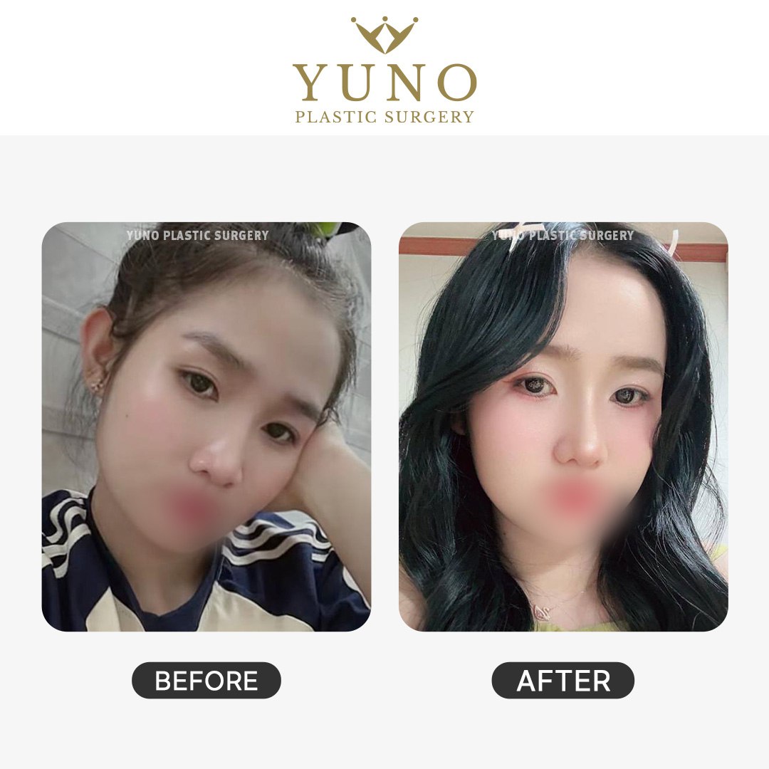 Yuno Plastic Surgery Indonesia Seoul