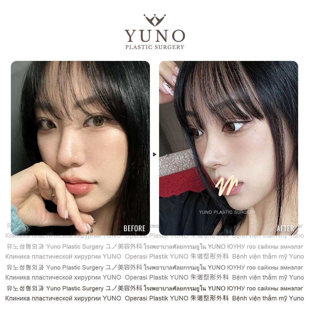 Yuno Plastic Surgery Indonesia Seoul