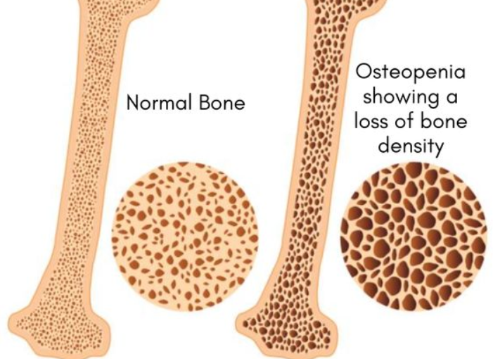 Osteoporosis Treatment Options Natural Remedies Support Group Usa Uk 1782