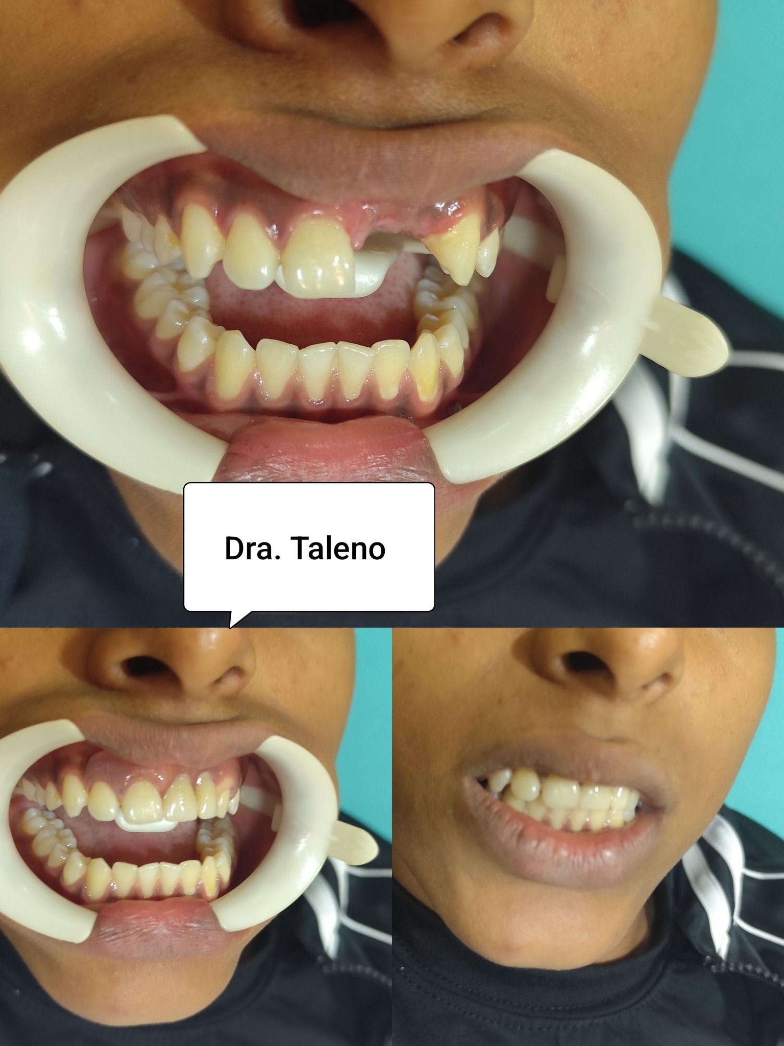 Clinica La Prótesis Removible Valplast Es Una Excelente Opción Para 3947