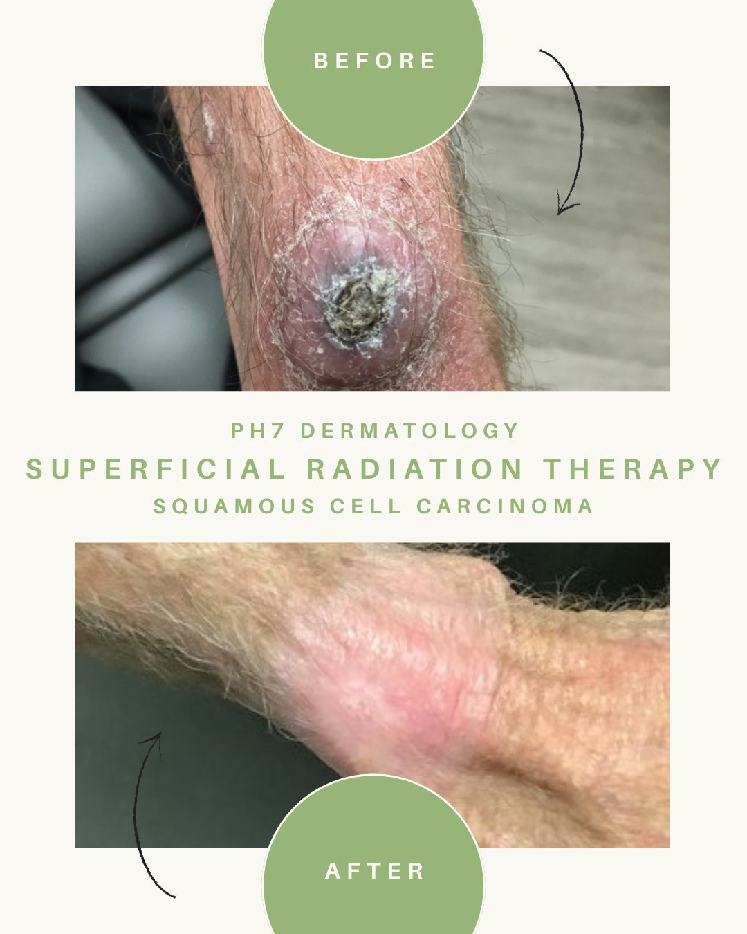 Ph7 Before And After Superficial Radiation Therapy For Squamous Cell 9186