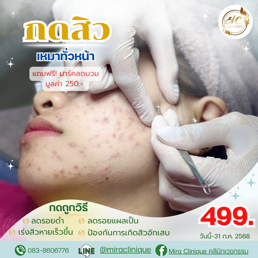 Mira สิวบุก หน้าพัง สิวเต็มหน้า 😭 ️ต้องรีบกดสิวด่วน 💥 เพราะการกดสิว