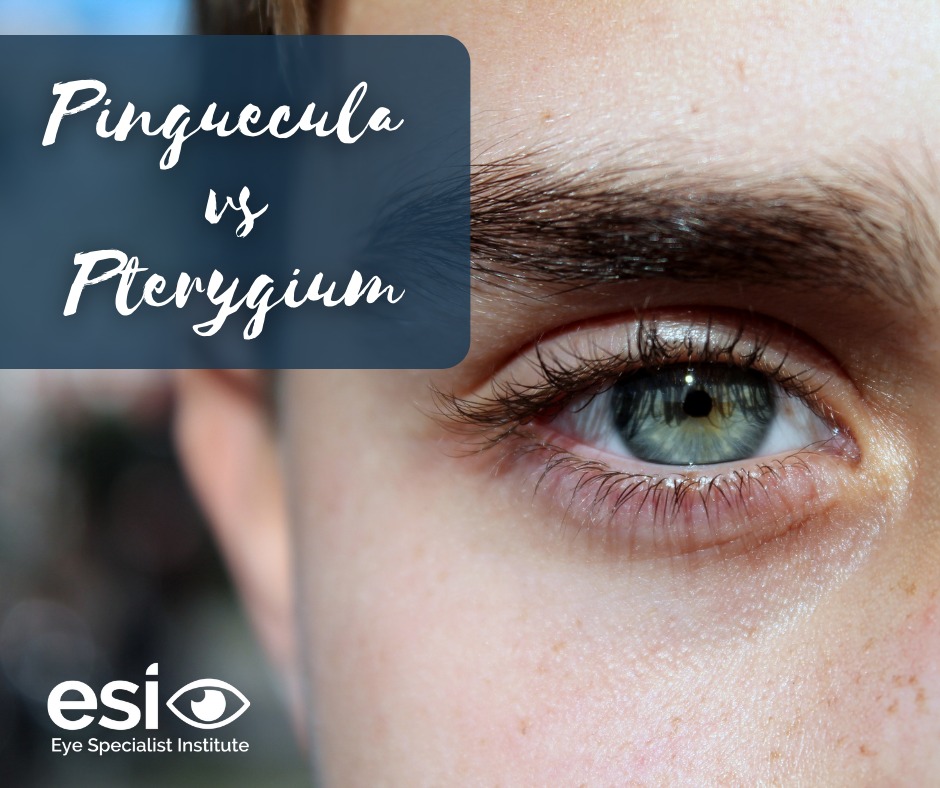 Pinguecula Vs Pterygium Eye Specialist Institute