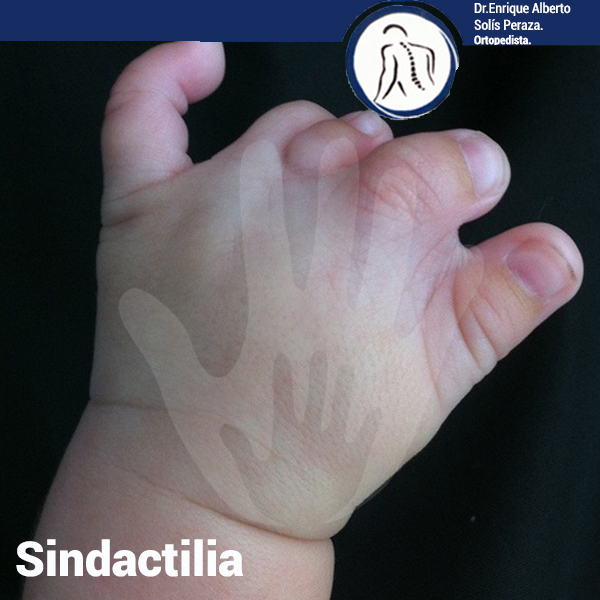 La Sindactilia Es Una Dr Enrique Alberto Solís Peraza Facebook
