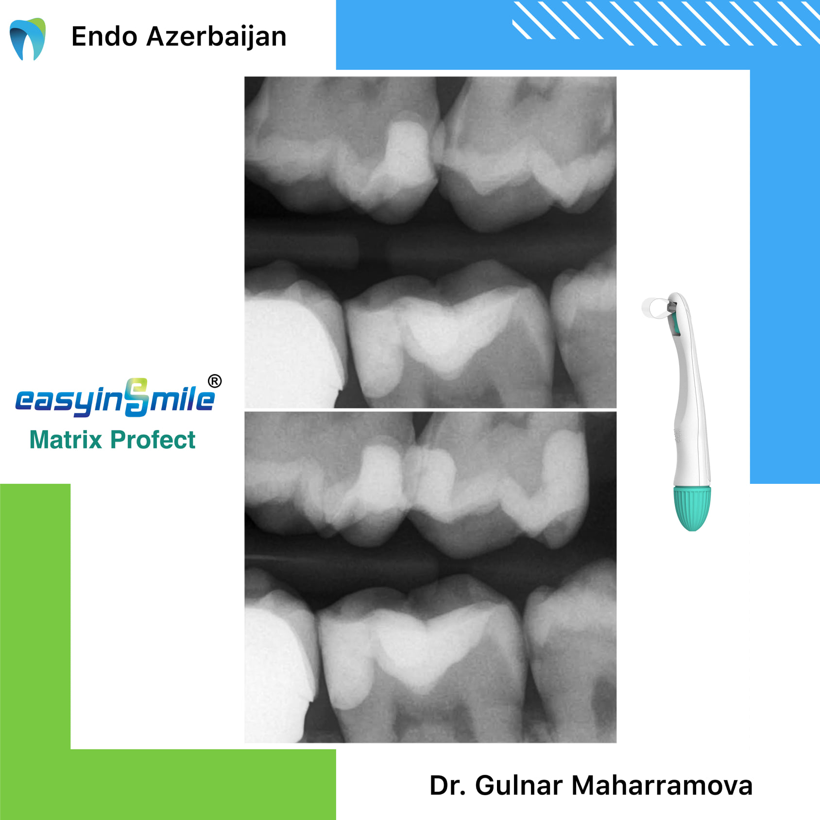 🇬🇧 Distal And Mesial Surfaces Of Upper Left Molar Restored By Means Of 6463
