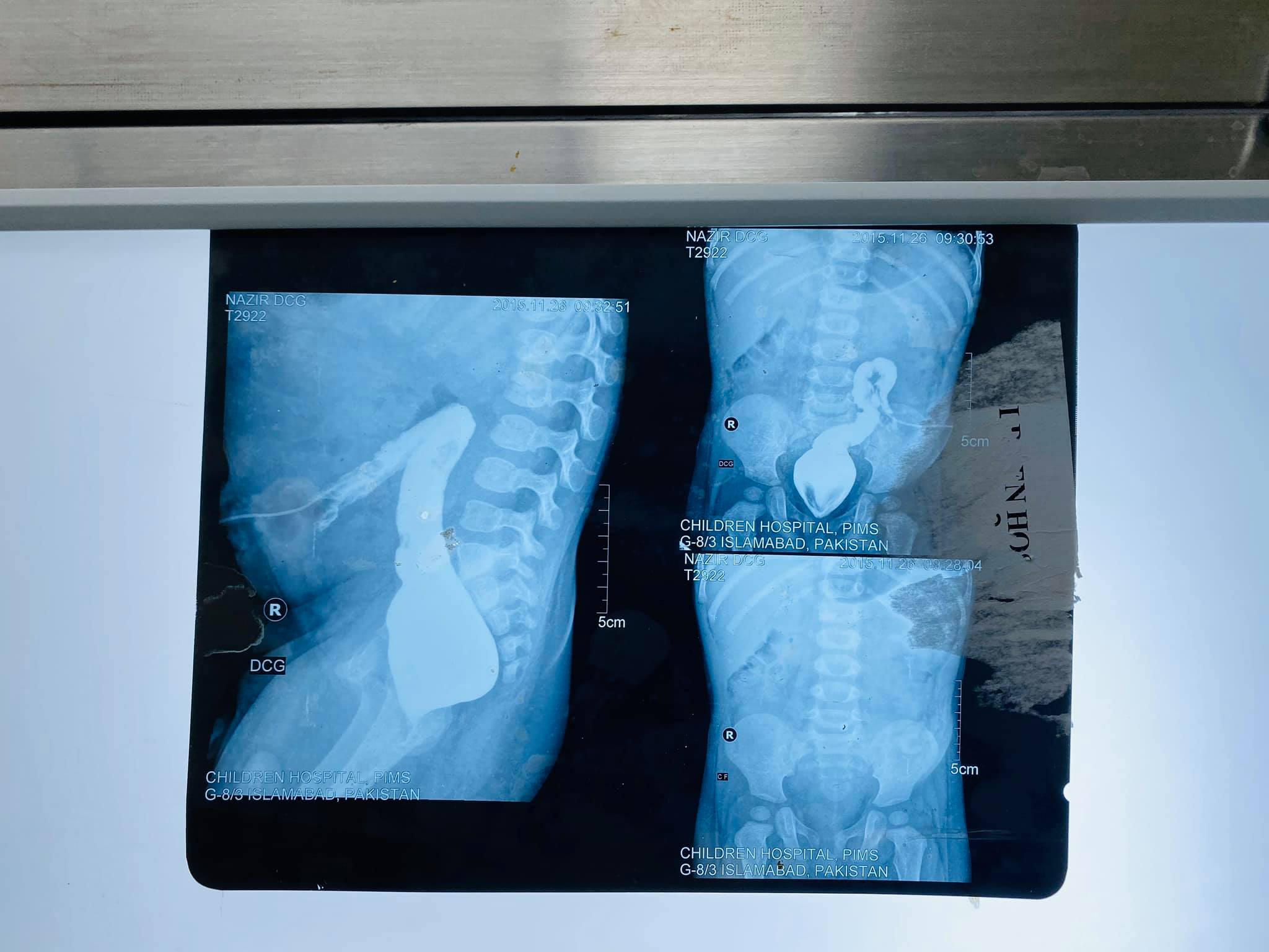 Profnadeem Akhtar Distal Loopogram Of Anorectal Malformation Patient 4920