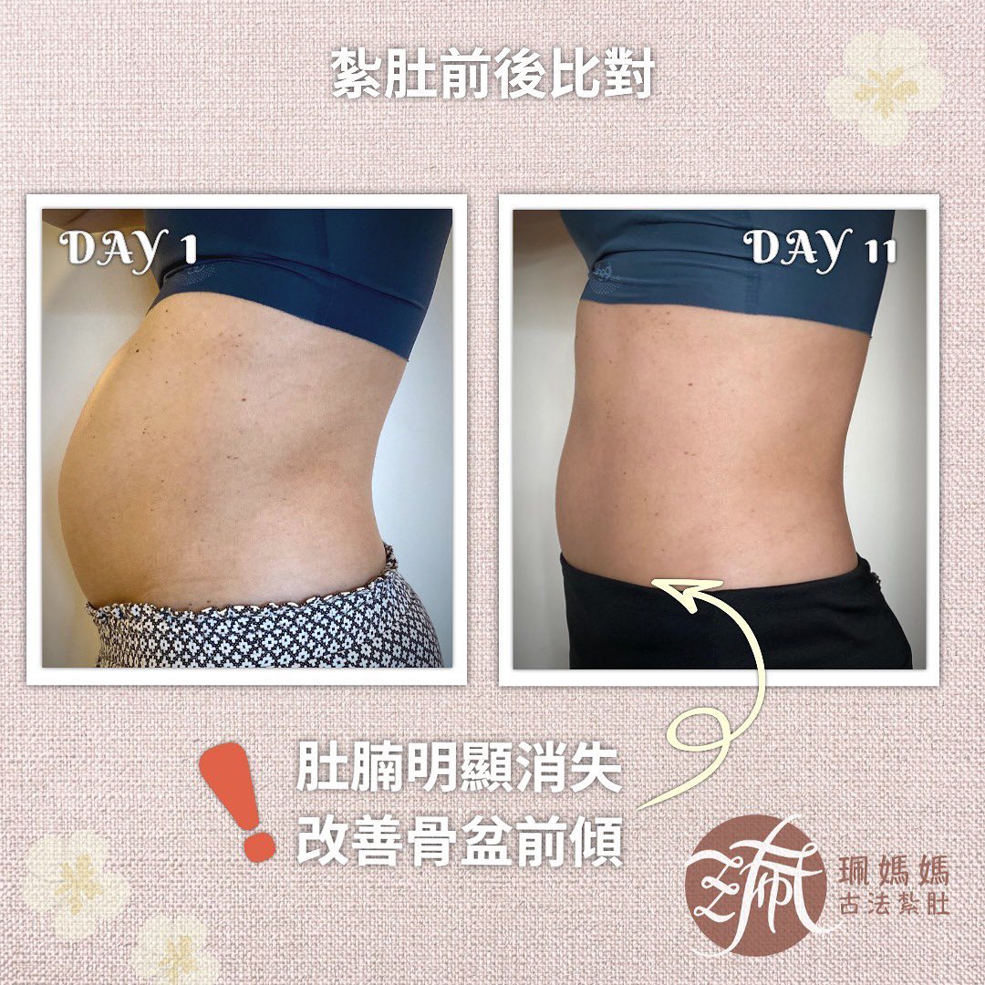 珮媽媽古法紮肚 【珮媽媽古法紮肚 前後比對】 11日療程，第二胎剖腹，產後5個月 Winnie