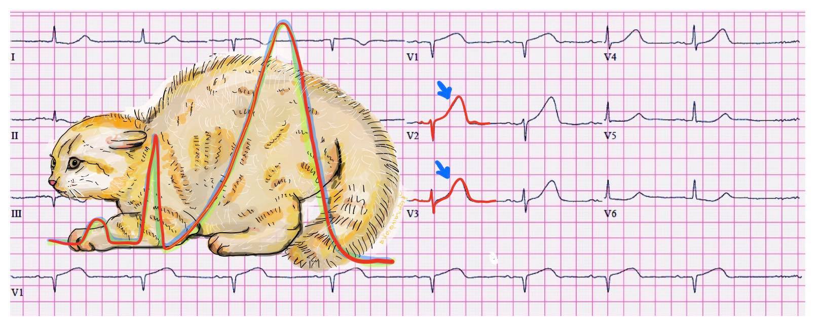 📌hyperacute T Wave ห้องฉุกเฉินต้องรู้