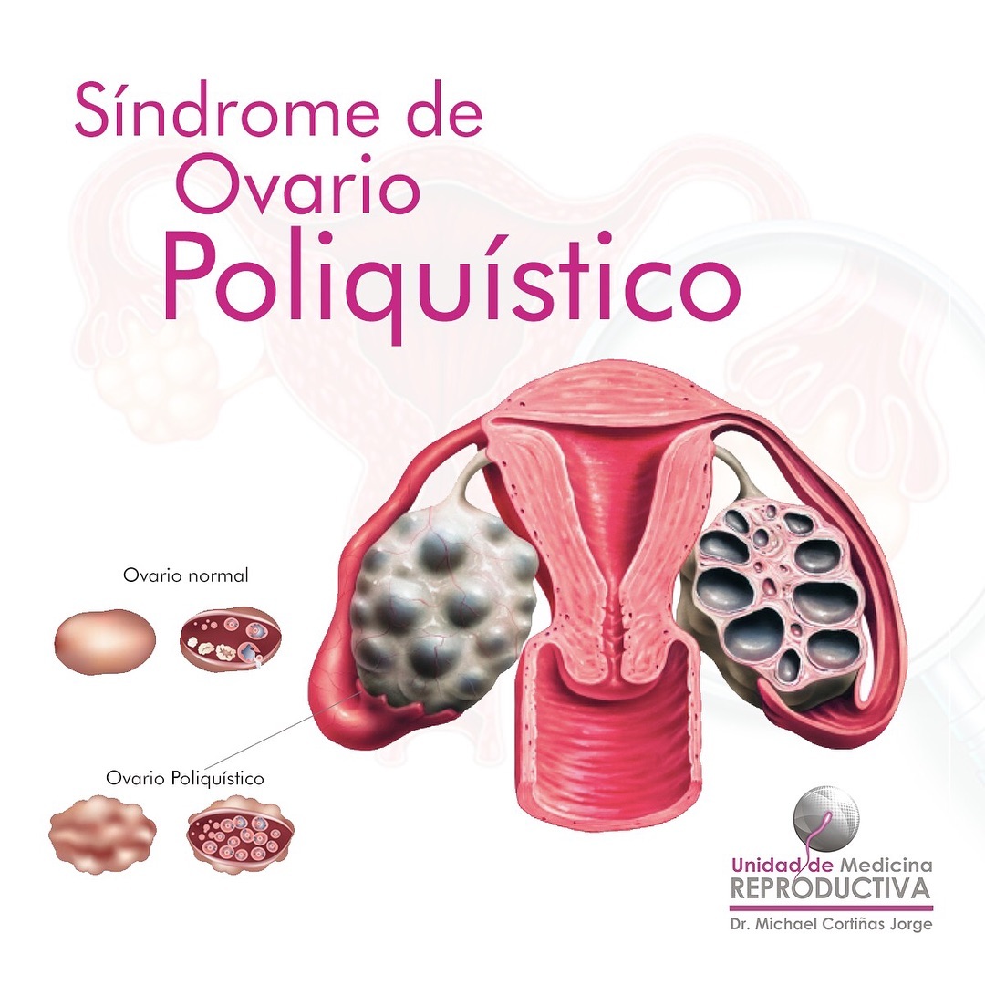 👉desliza 👆el Síndrome De Ovario Poliquístico Sop Es Un Desorden 4953