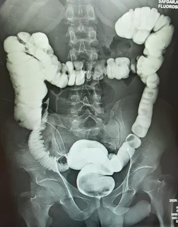 Distal Loopogram Loopogram Facebook 2824