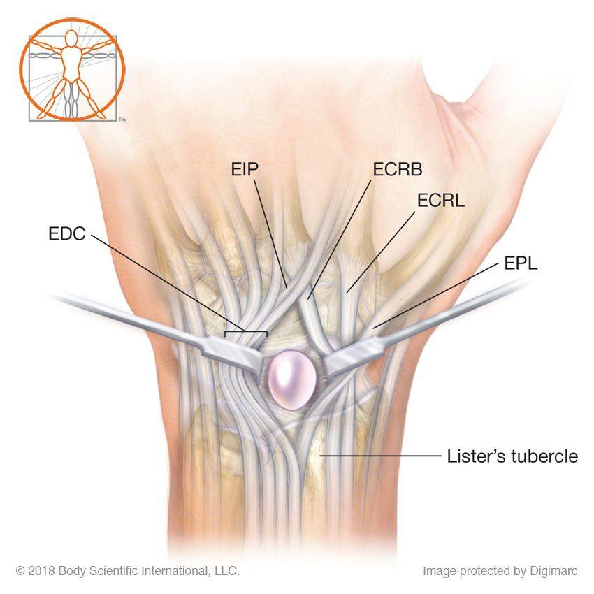 Ganglion Cyst Diagram 0258