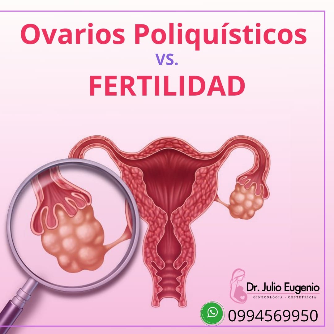 ¿influyen Los Ovarios PoliquÍsticos En Dr Julio Eugenioemk 9143