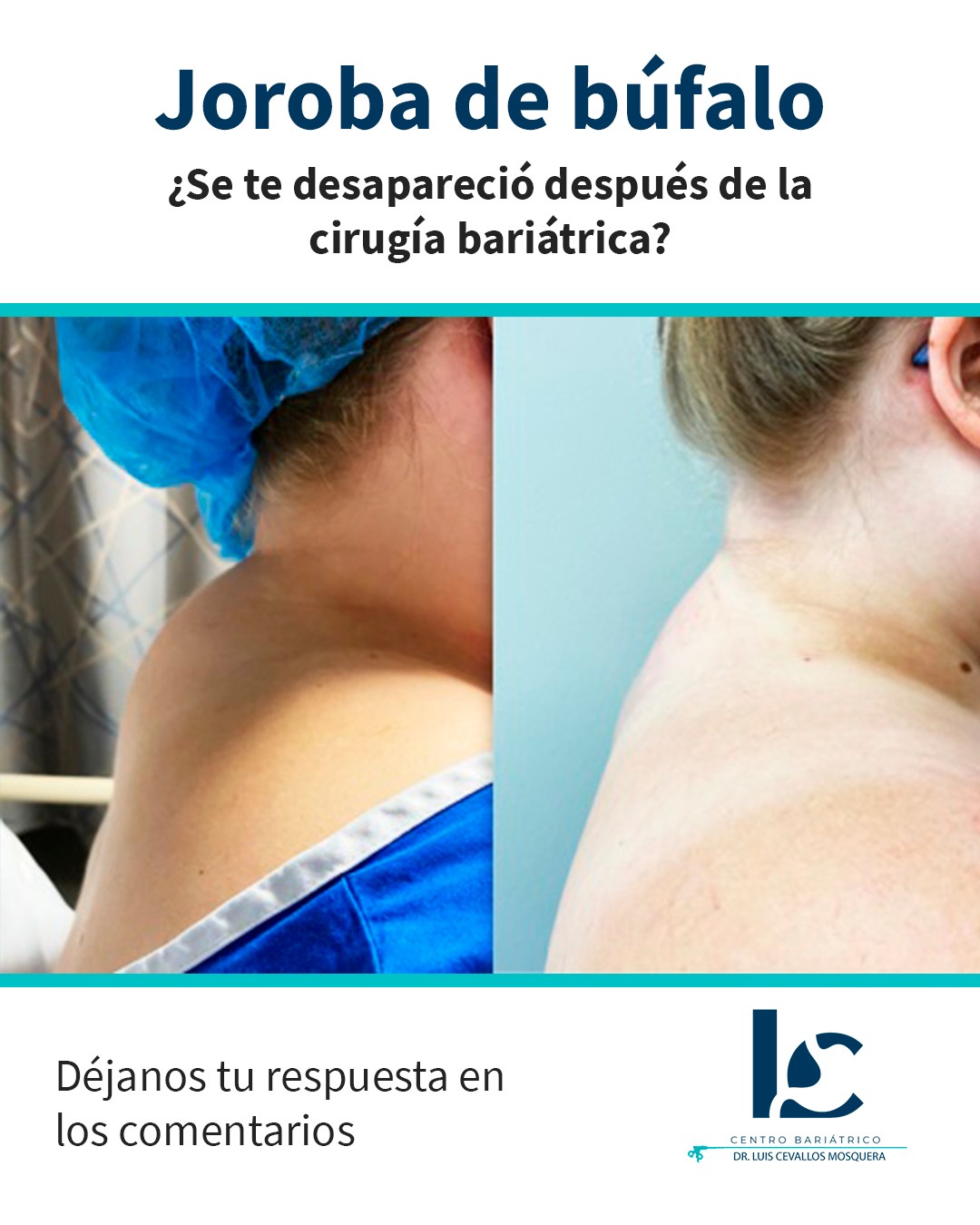 La Joroba De Búfalo Es Una Acumulación Dr Luis Cevallos