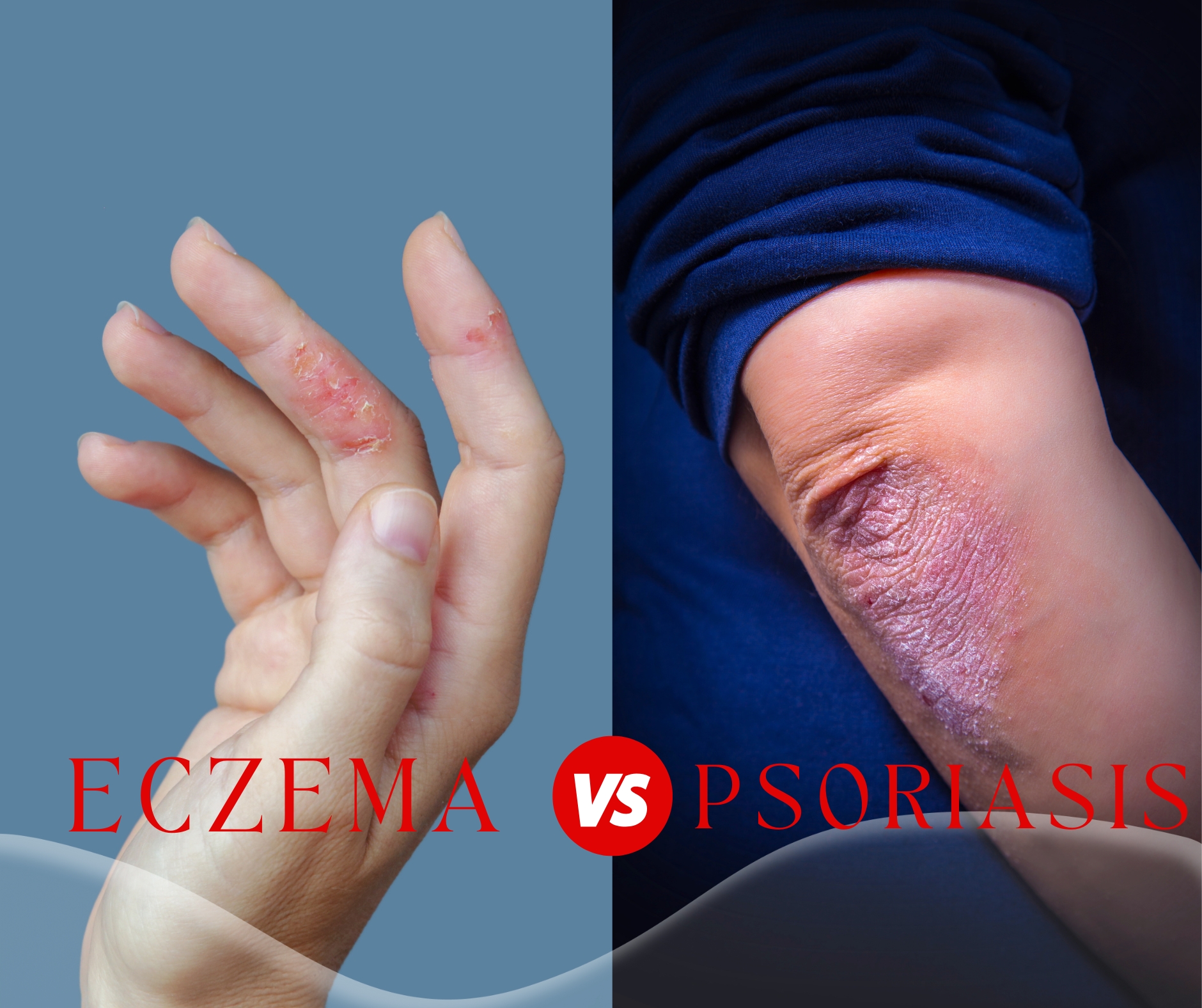 🌼 Psoriasis Vs Philippines Dermatology Institute 8327