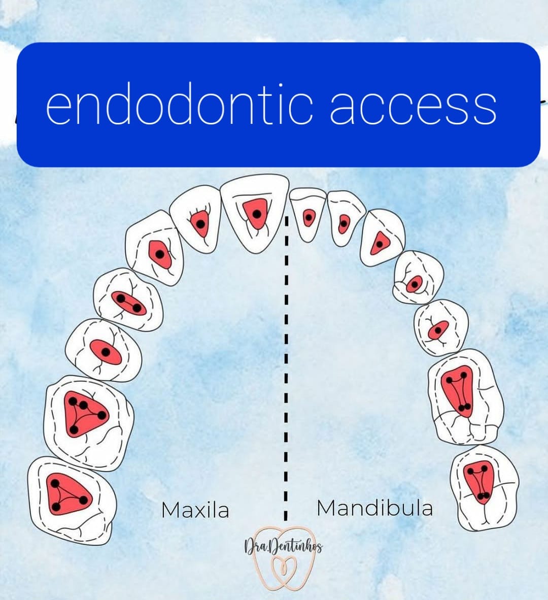 Access Cavity Of Upper And Lower Teeth علاج جذور الأسنان 5159