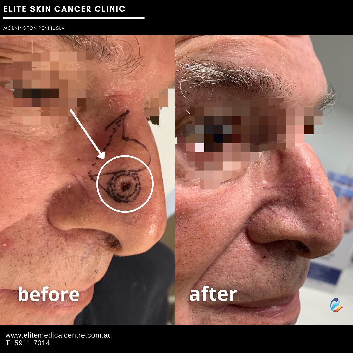 9 Mm Skin Cancer Bcc On Elite Medical Mornington Facebook