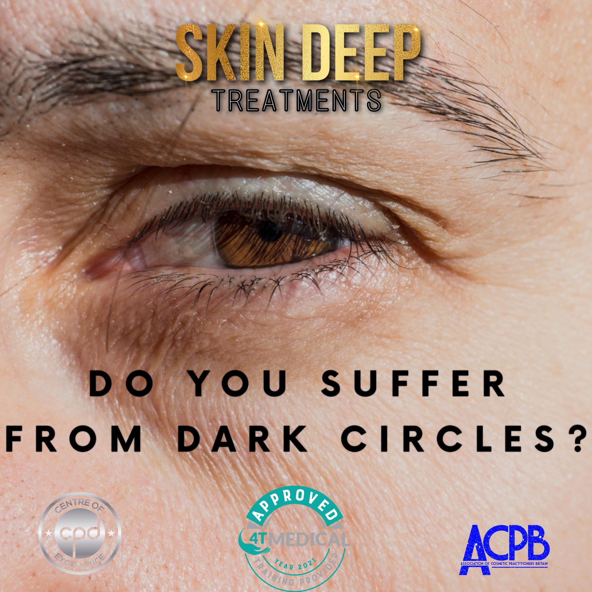 Dark Circles ⚜️new Skin Deep Treatments Yorkshire 7801