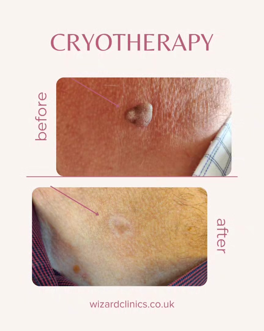 Wizard Clinics Seborrheic Keratosis Removal This Facebook 8367
