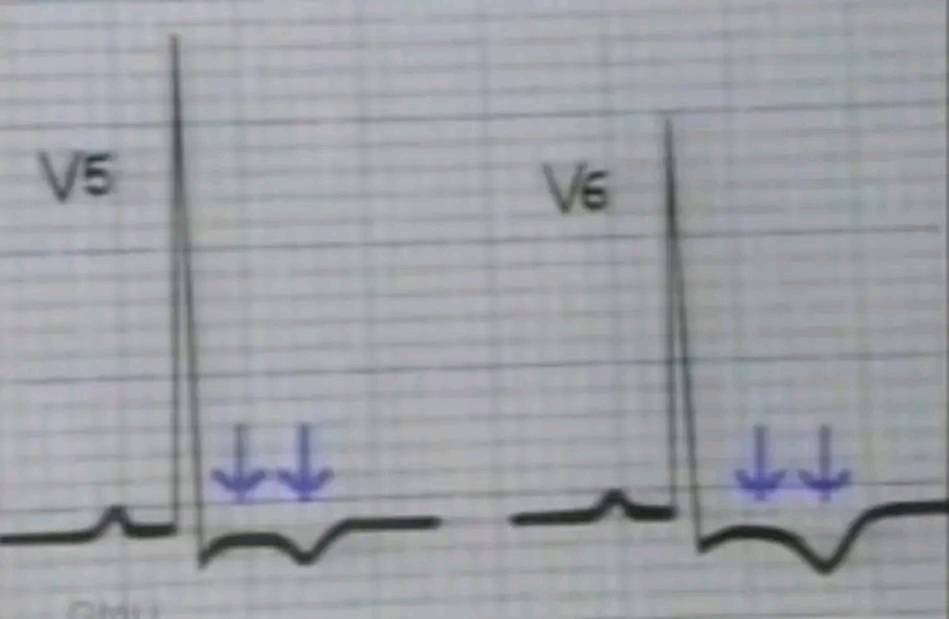 Strain Pattern Is Seen In Left Cardiology Online 1345
