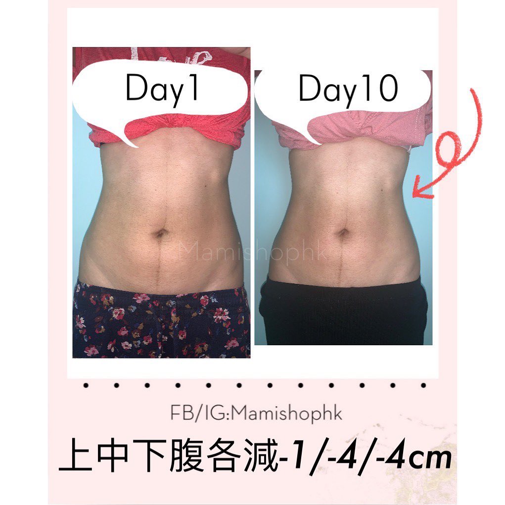 又一位媽咪完成左十天紮肚療程👏🏻👏🏻👏🏻 Mamishophk 古法紮肚，產後修身