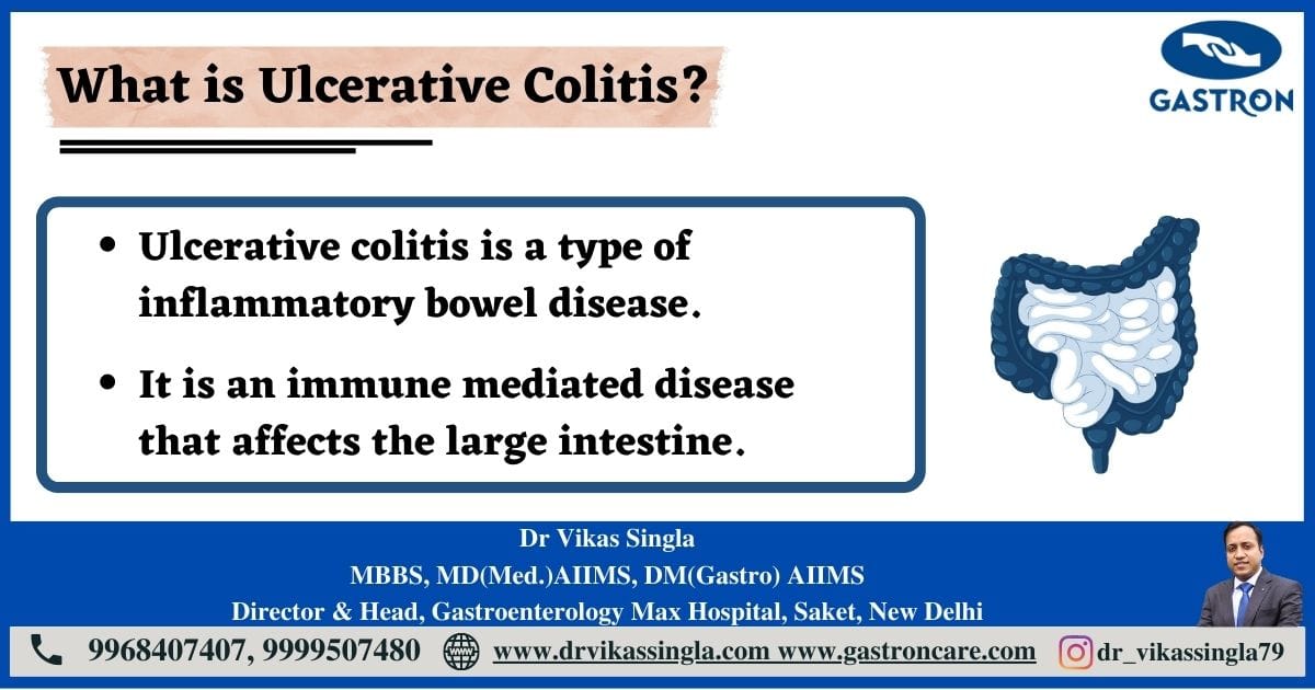 What Ulcerative Colitis Dr Vikas Singla 6697