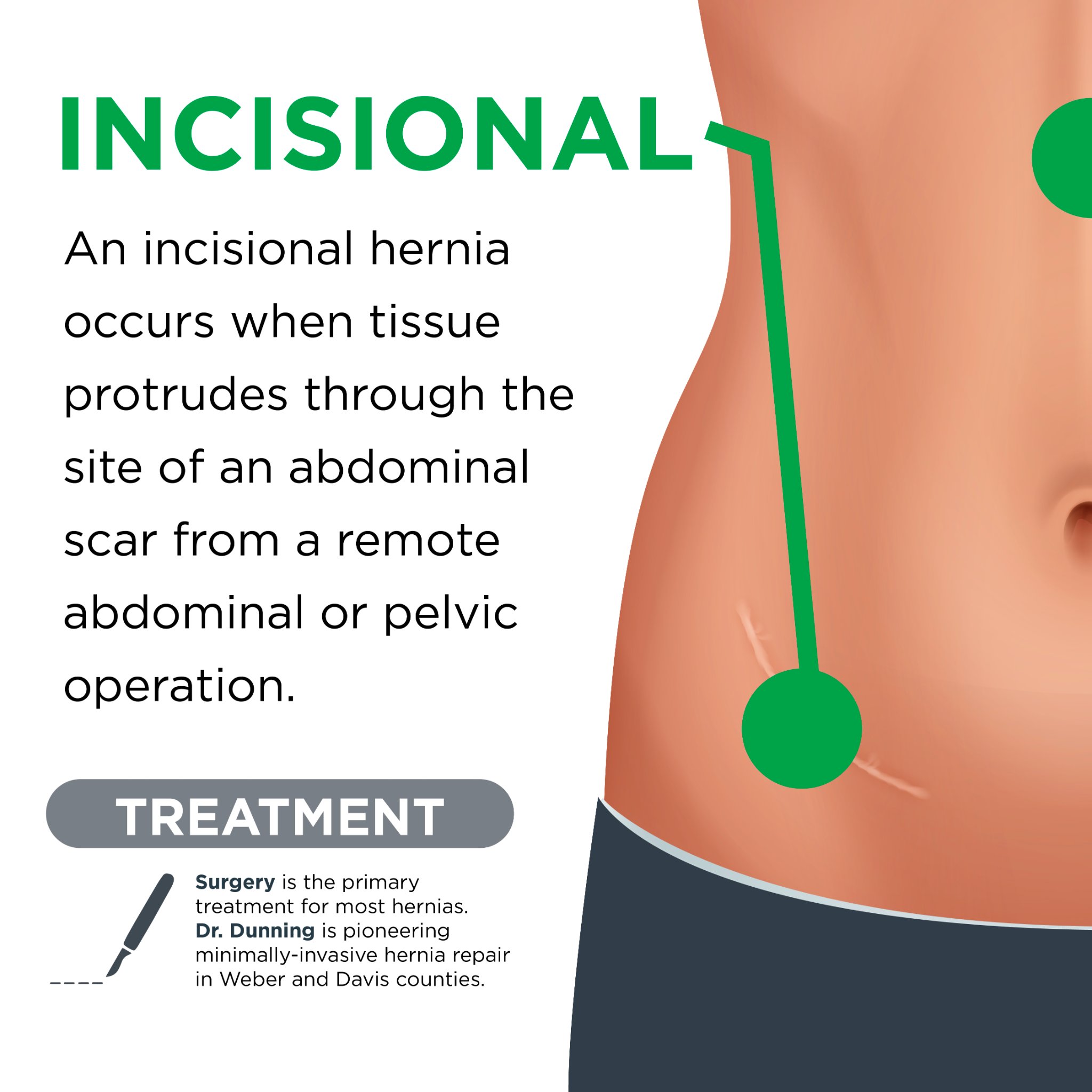 Incisional Hernia Repair Incisional Ventral Hernia Repair Surgery 0038