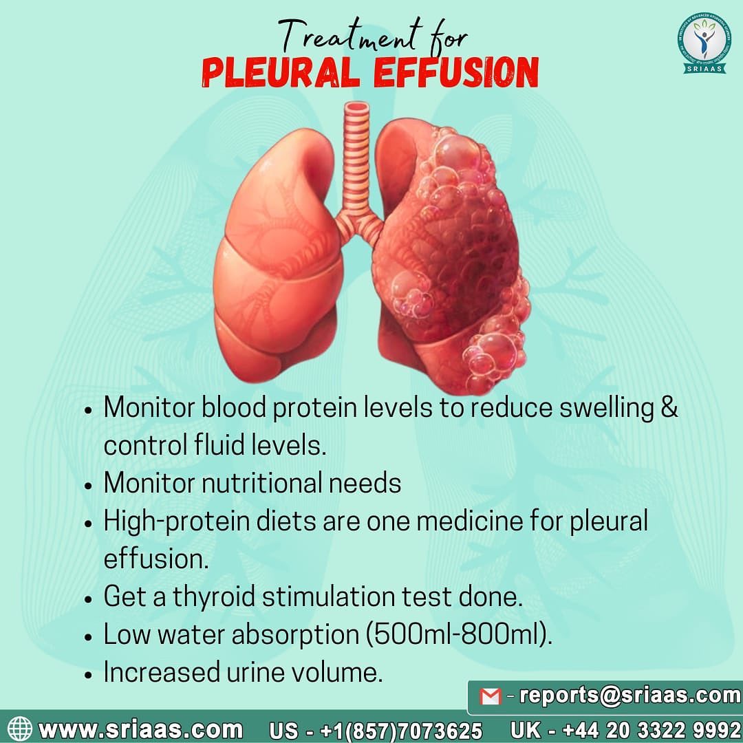 Sriaas A Pleural Effusion Is An Abnormally Large Quantity Of Fluid