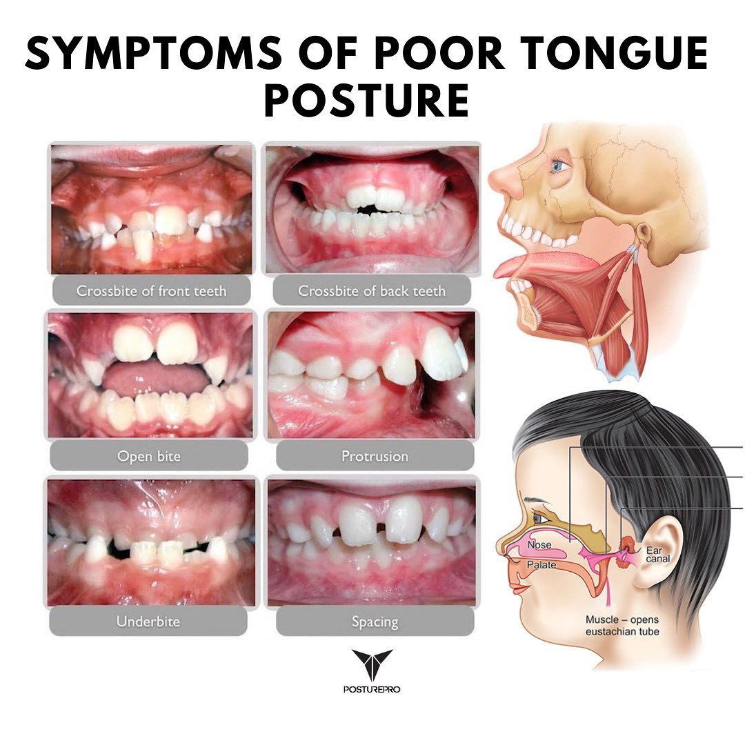 Posturepro - Proper tongue posture is more important than...