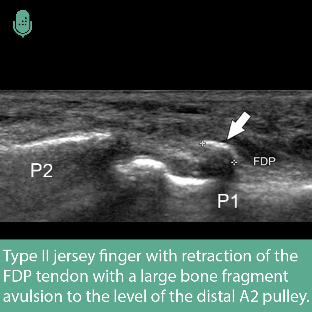 Orthobullets The Patient Below Sustained A Leddy Packer Facebook