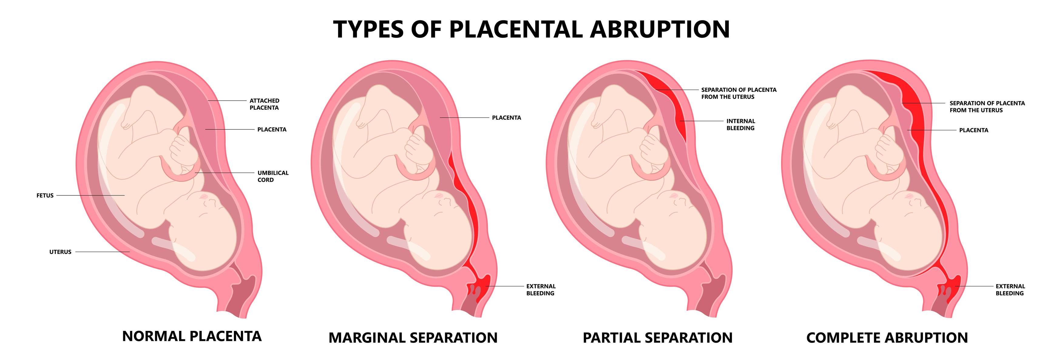 Abruptio Placentae Is The Premature