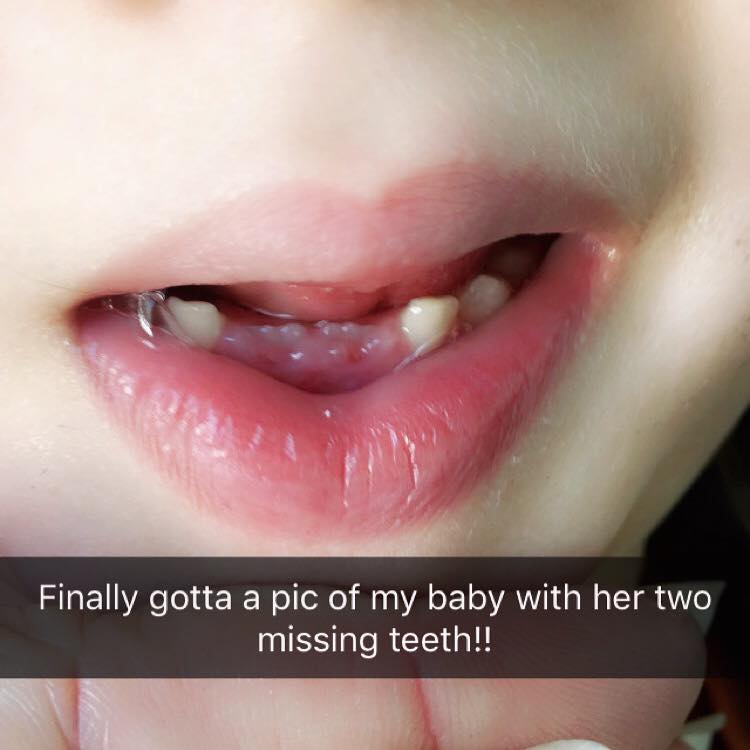 Roar4danika Danika Lost Her First Two Teeth Fri And Sat Facebook