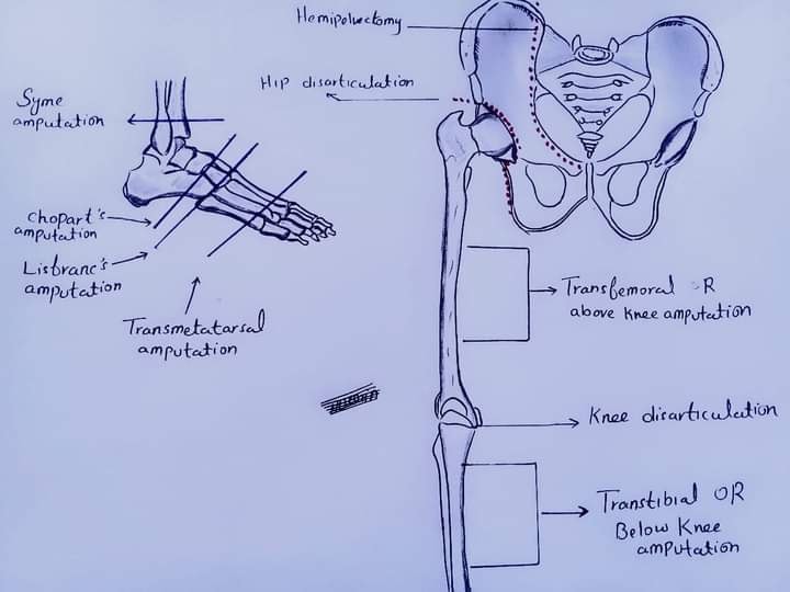 Amputation Levels In Lower All Physiotherapist Doctors Facebook