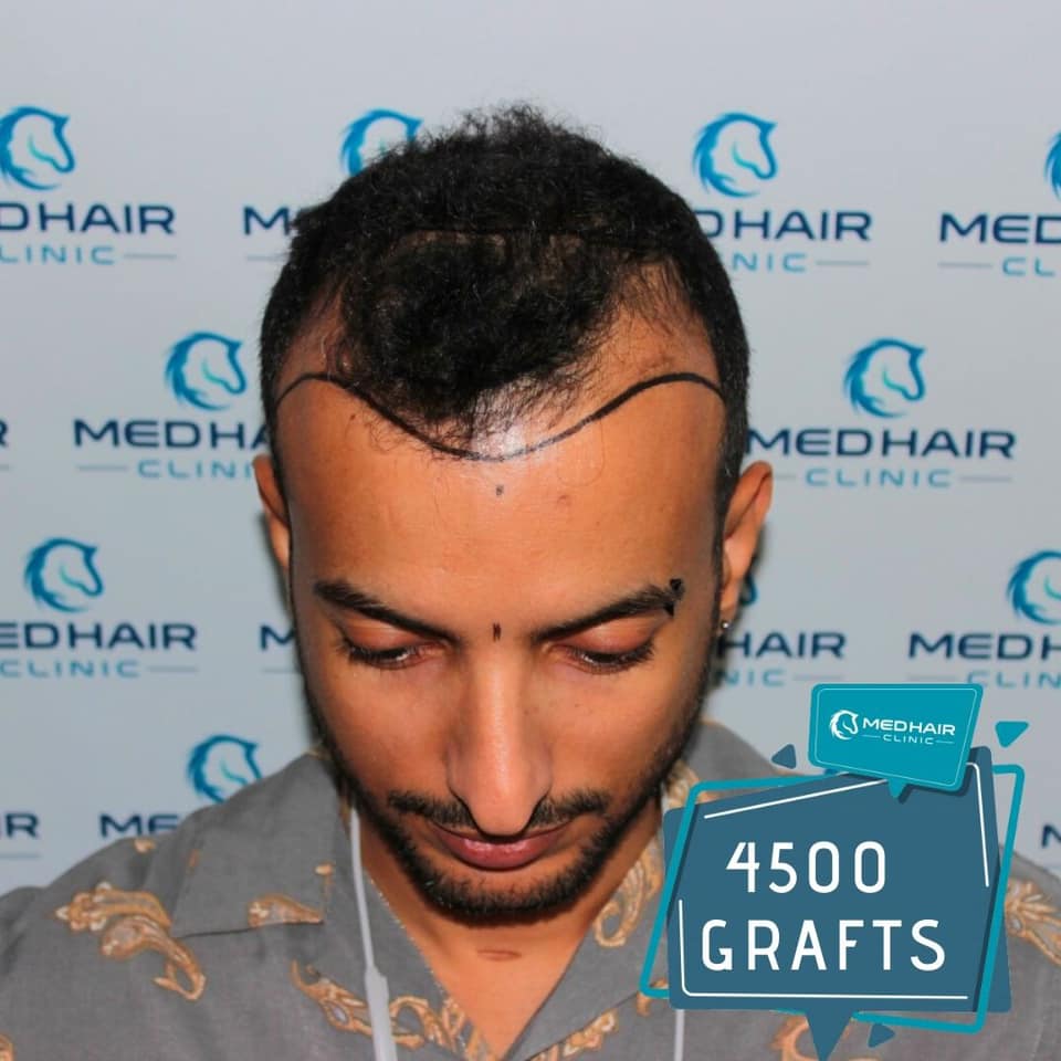 Medhair Clinic 📌our Patient Has Undergone A Hair