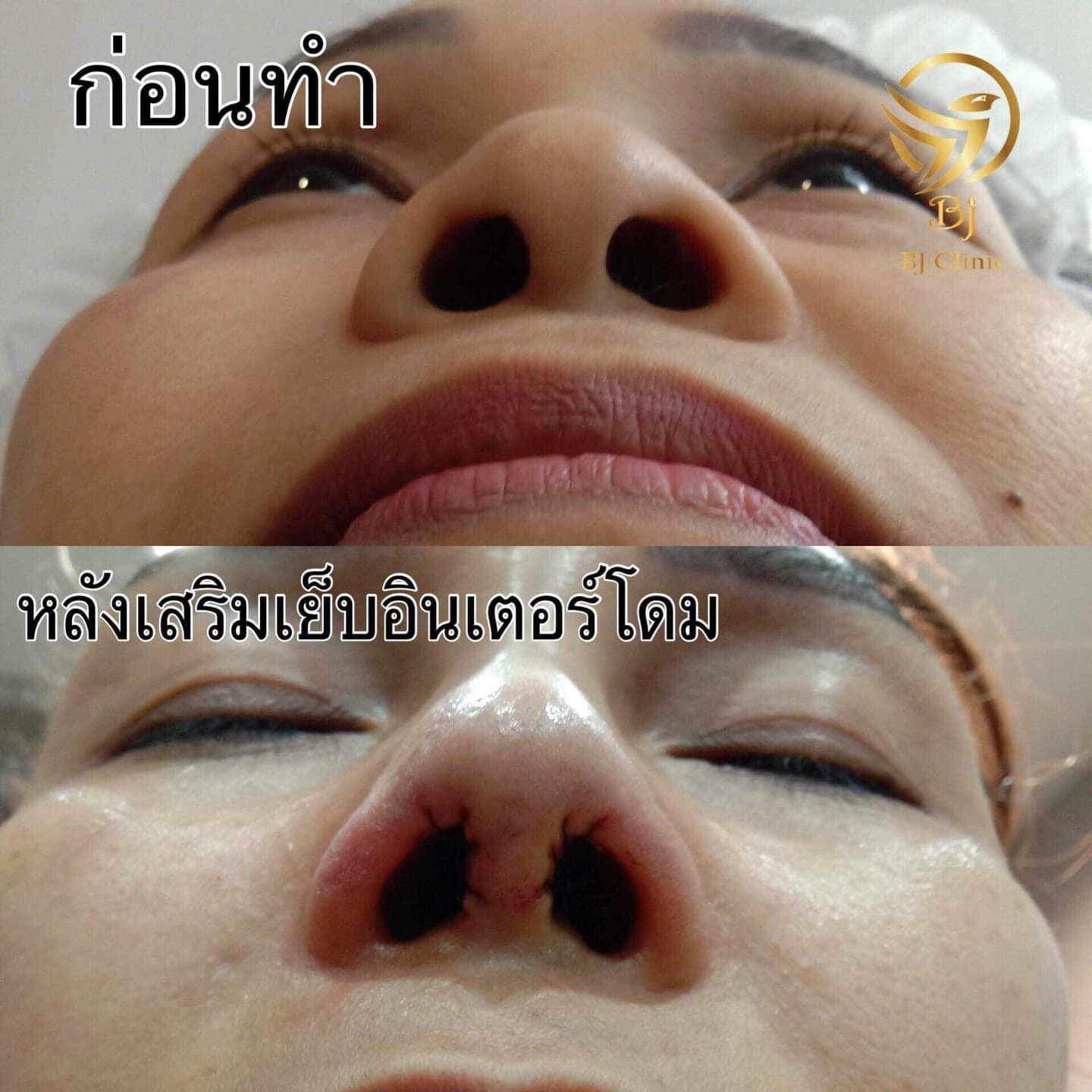 โปรเสริมใหม่ อินเตอร์โดม Bj Clinic รามคำแหง24 Thailand Facebook