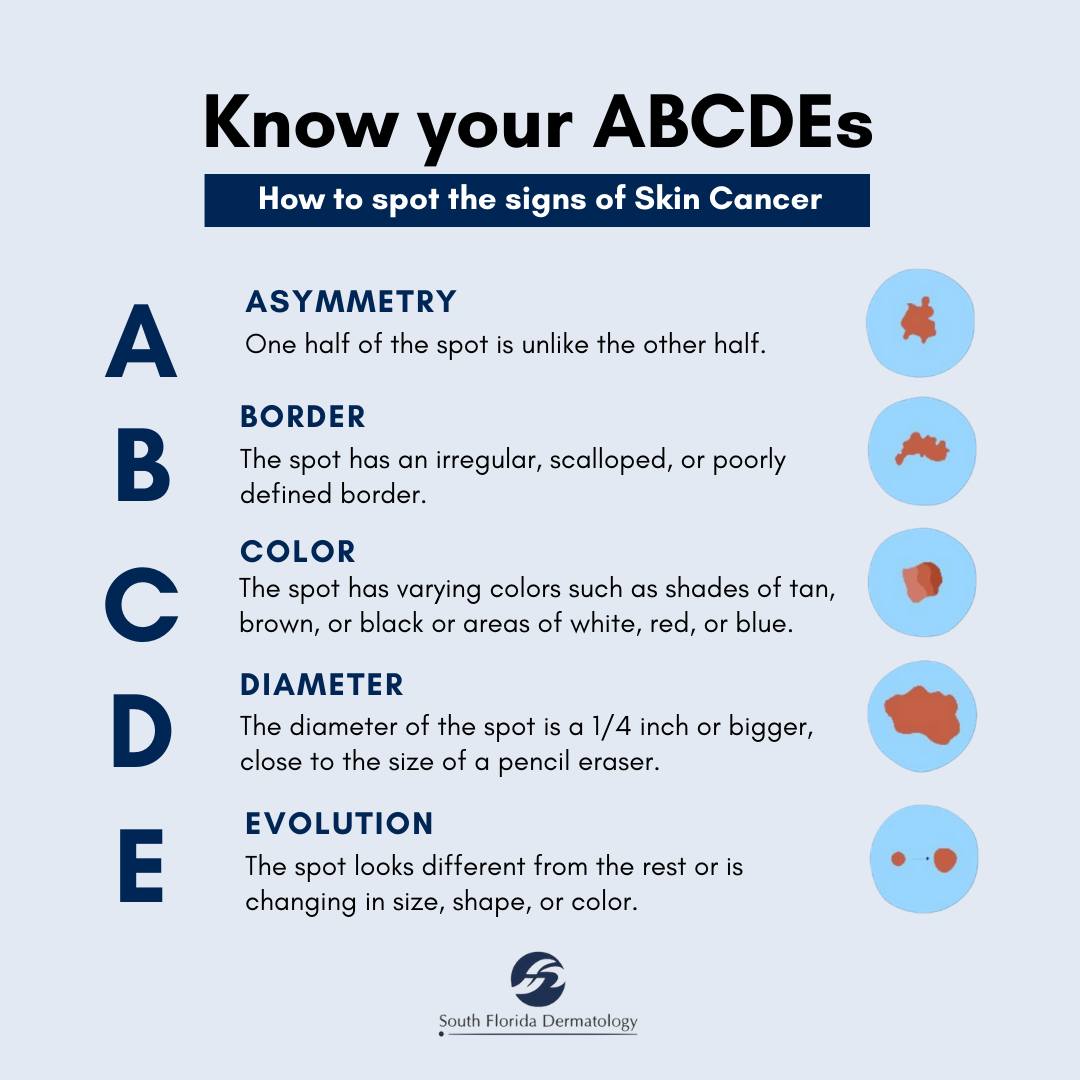 Know the ABCDEs of skin cancer... - South Florida Dermatology