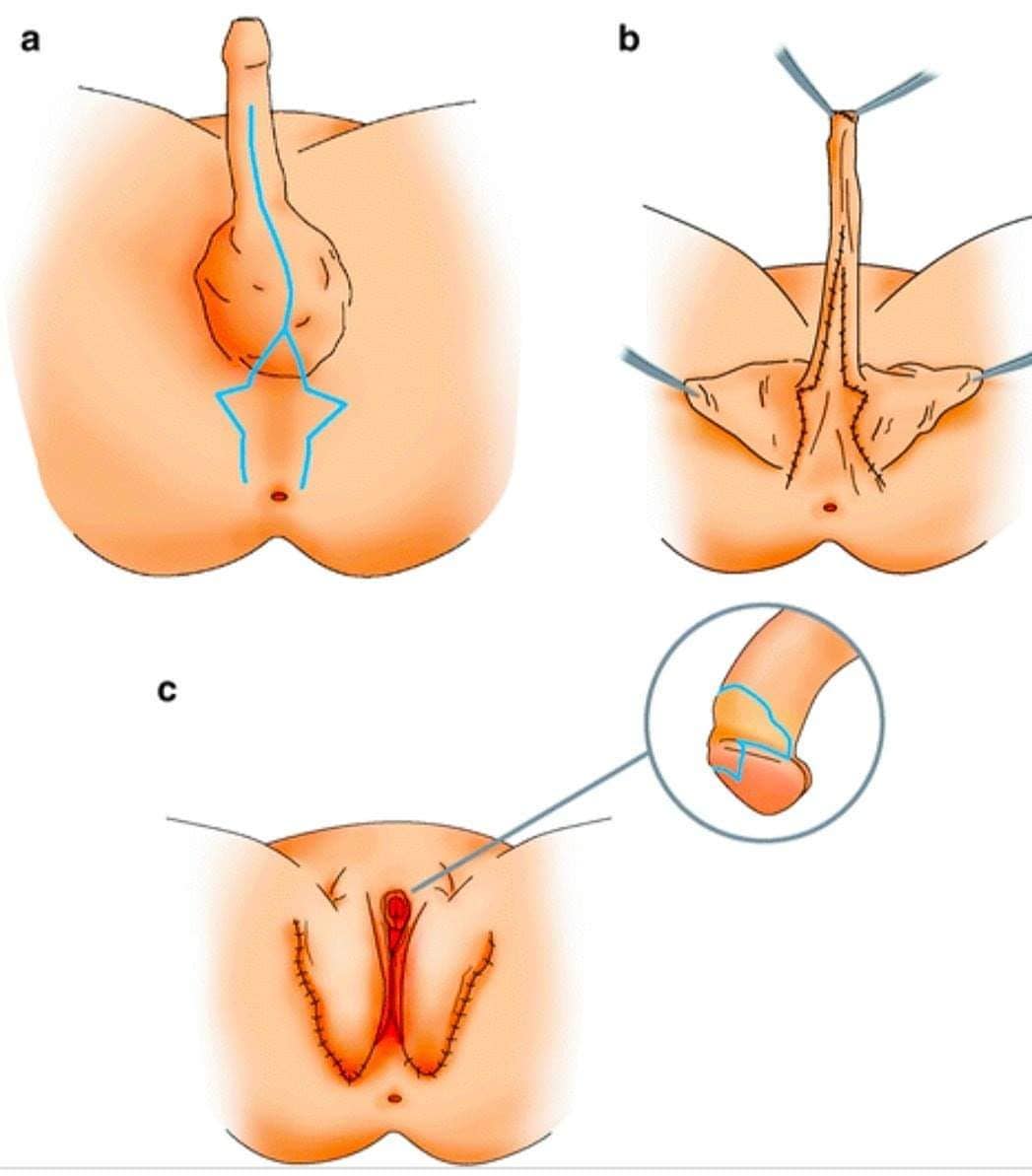Gender Reassignment Surgery Is A Transgender Clinic Facebook