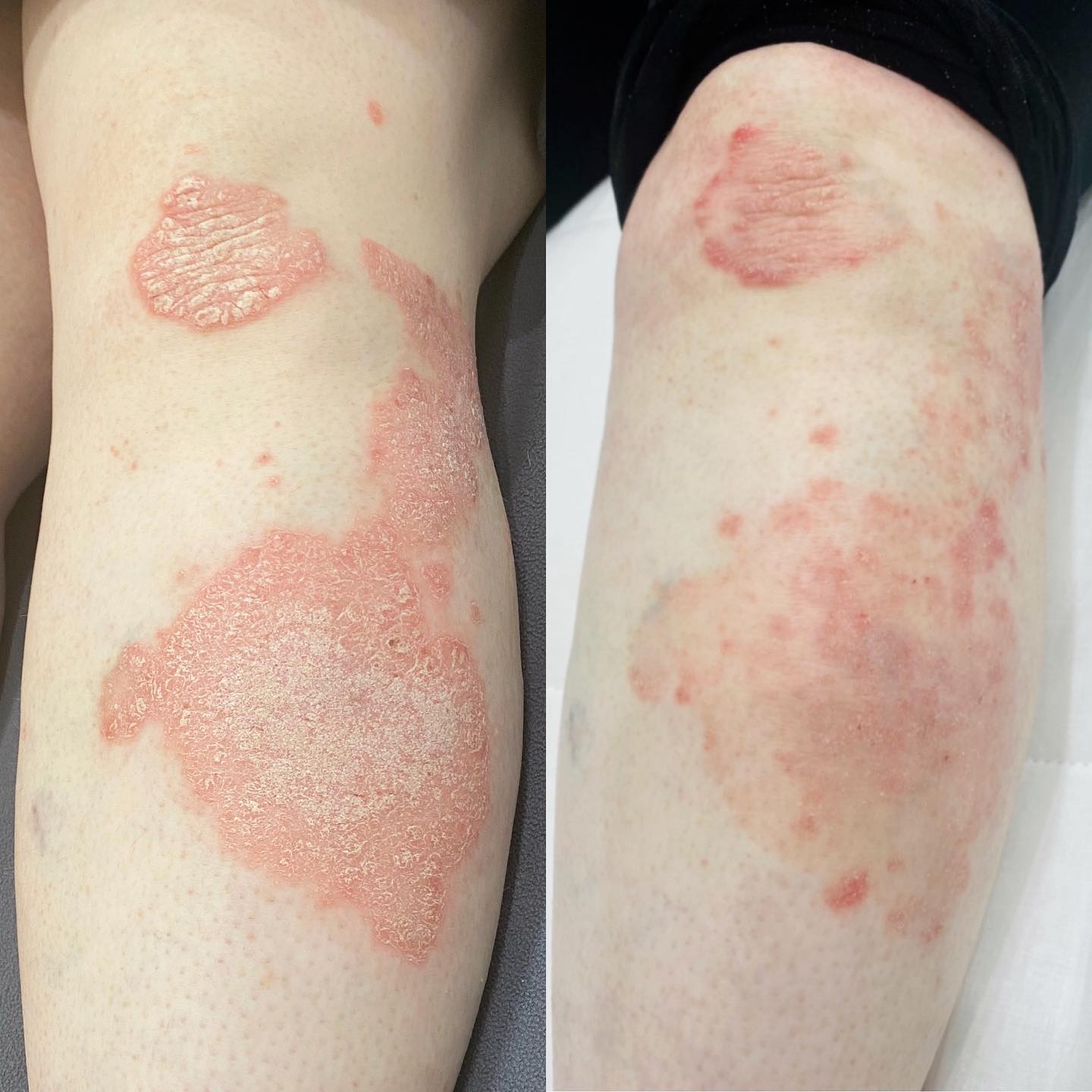Psoriasis Pityriasis Rosea Symptoms And Causes 56 Off 7602