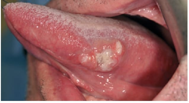 Drzehra Squamous Cell Carcinoma Of The Tongue Is A Common Type Of 3226