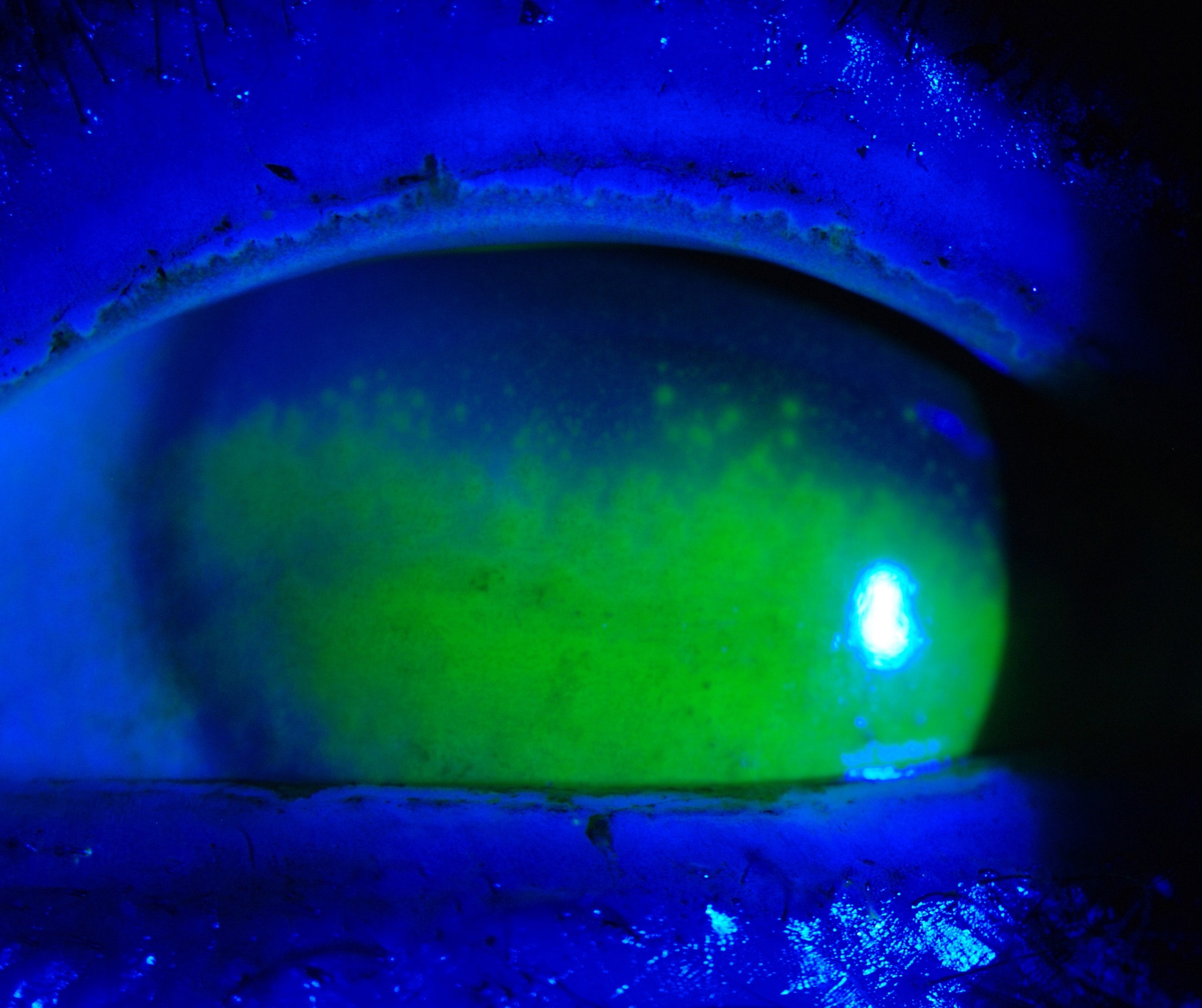 A Novel Dry Eye Classification Tool Optometry Advisor 3472