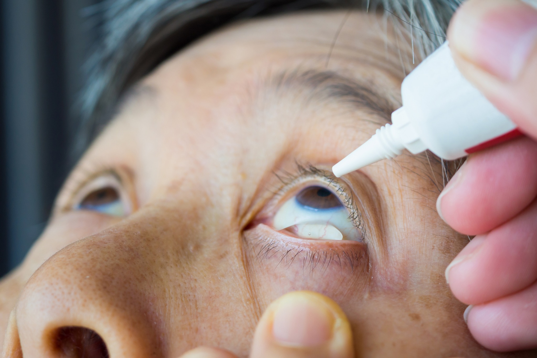A Novel Dry Eye Classification Tool Optometry Advisor 6335